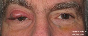 Chalazion Causes, Symptoms, Home Treatment, Surgery, Pictures - eHealthStar