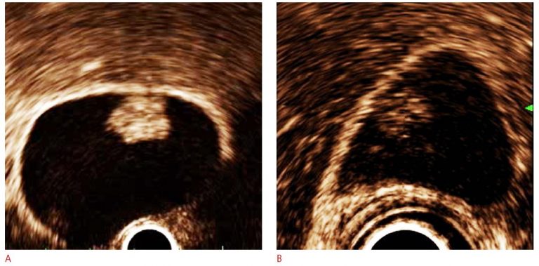 Gallbladder Polyps Causes, Symptoms, Cancer, Radiology, Treatment ...